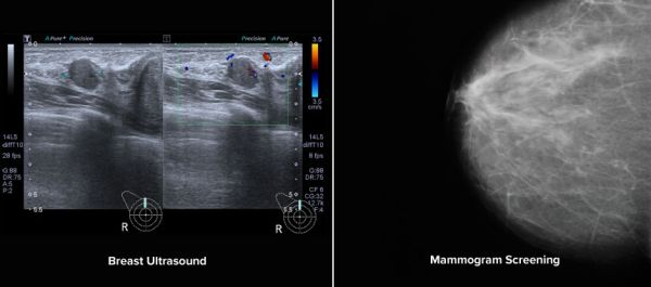 Mammogram vs. Ultrasound: Which Breast Cancer Screening is Right for ...